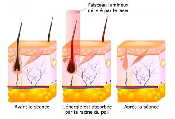 Epilation définitive par laser - Bordeaux Libourne
